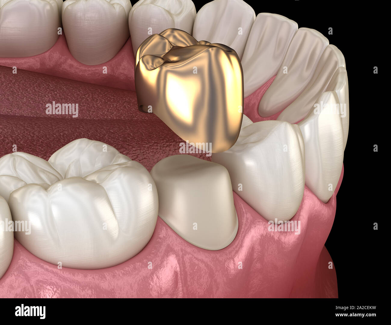 Golden crown premolar tooth assembly process. Medically accurate 3D ...