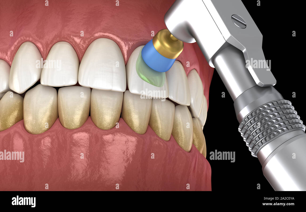 Teeth polishing procedure with professional brush and gel. Medically ...