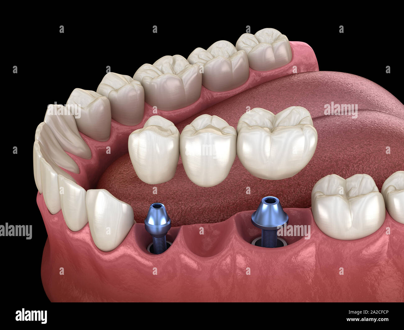 Dental bridge supported by implants. Medically accurate 3D illustration ...