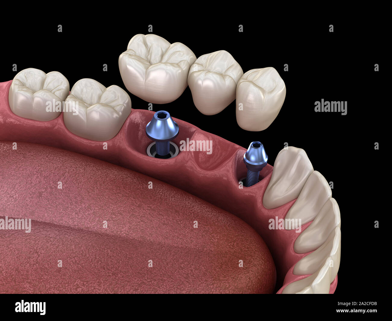 Dental bridge supported by implants. Medically accurate 3D illustration ...
