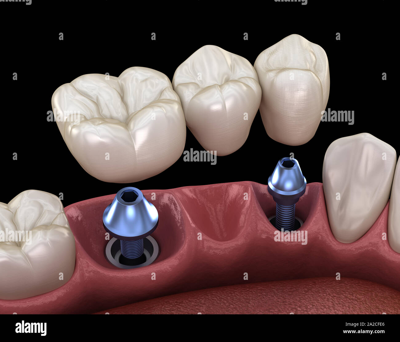 Dental bridge supported by implants. Medically accurate 3D illustration ...