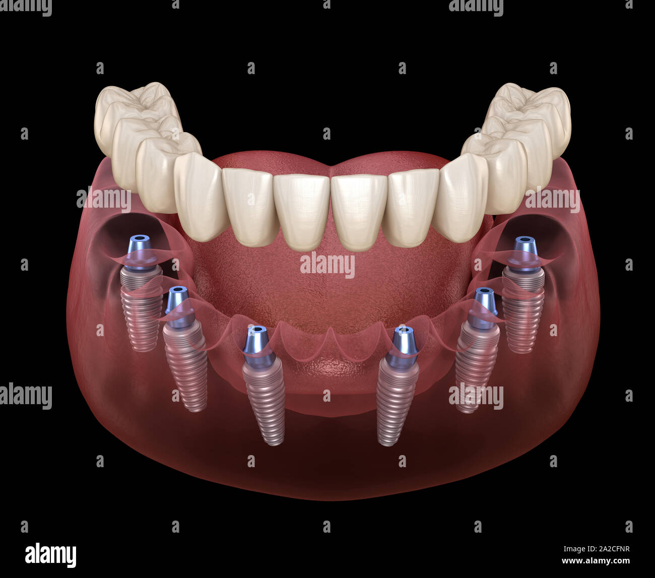 Mandibular prosthesis All on 6 system supported by implants. Medically ...
