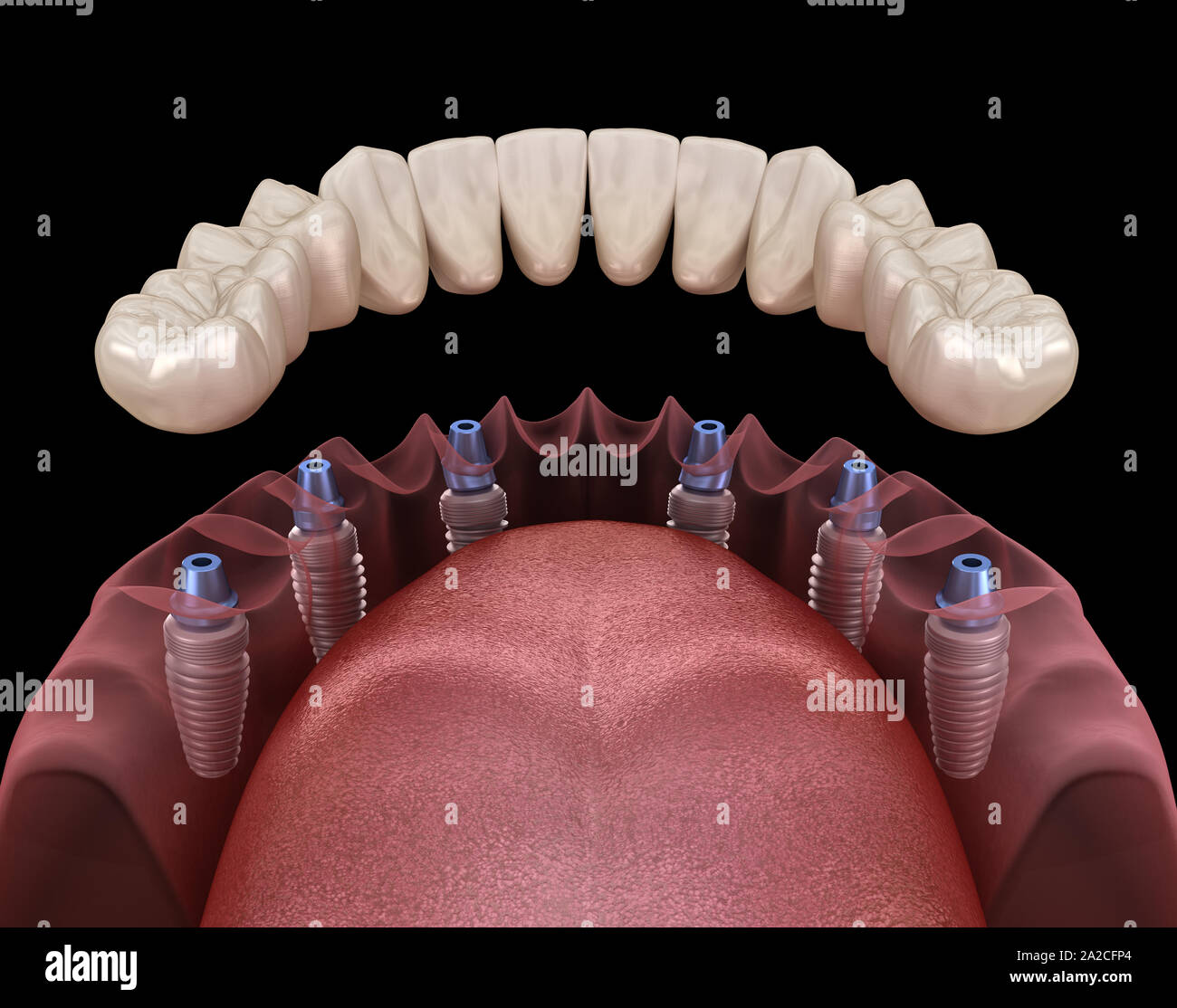 Mandibular prosthesis All on 6 system supported by implants. Medically ...