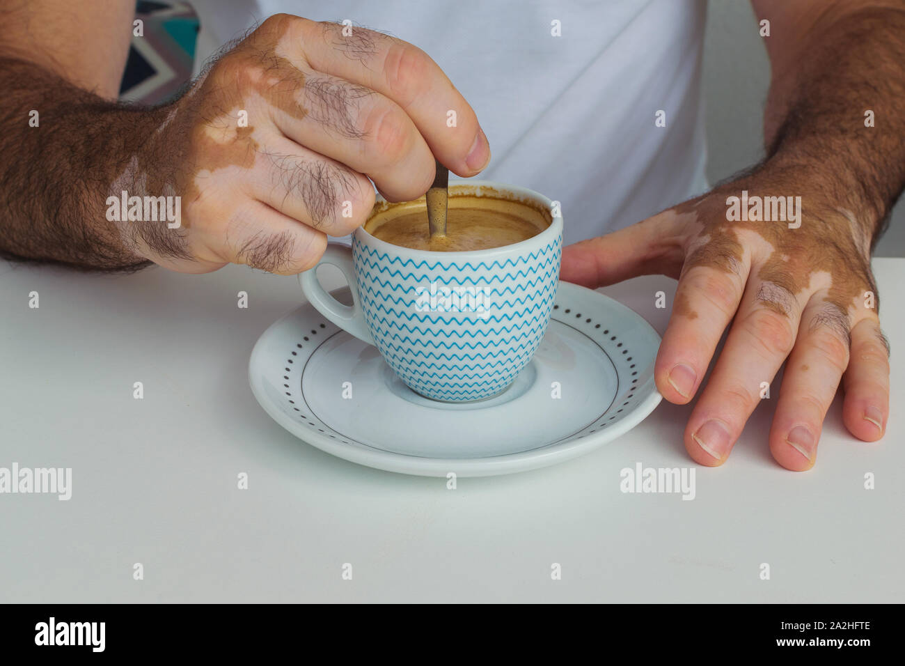 Patchy loss of skin color hi-res stock photography and images - Alamy