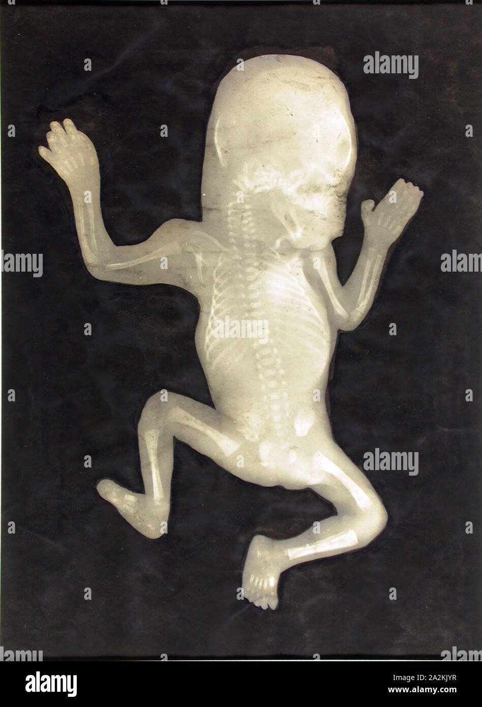 3 month fetus hi-res stock photography and images - Alamy