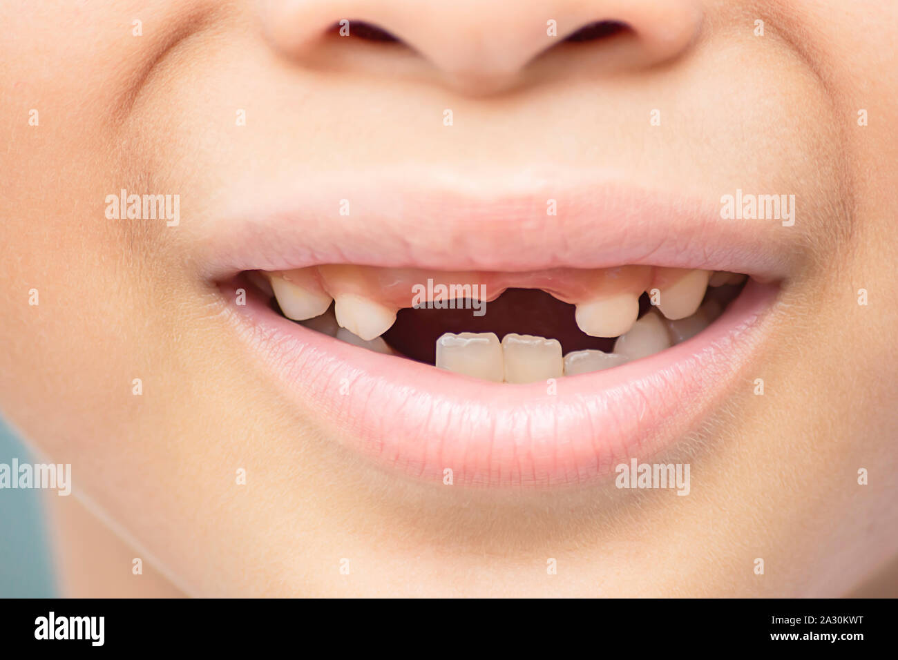 Baby teeth loss hi-res stock photography and images - Alamy