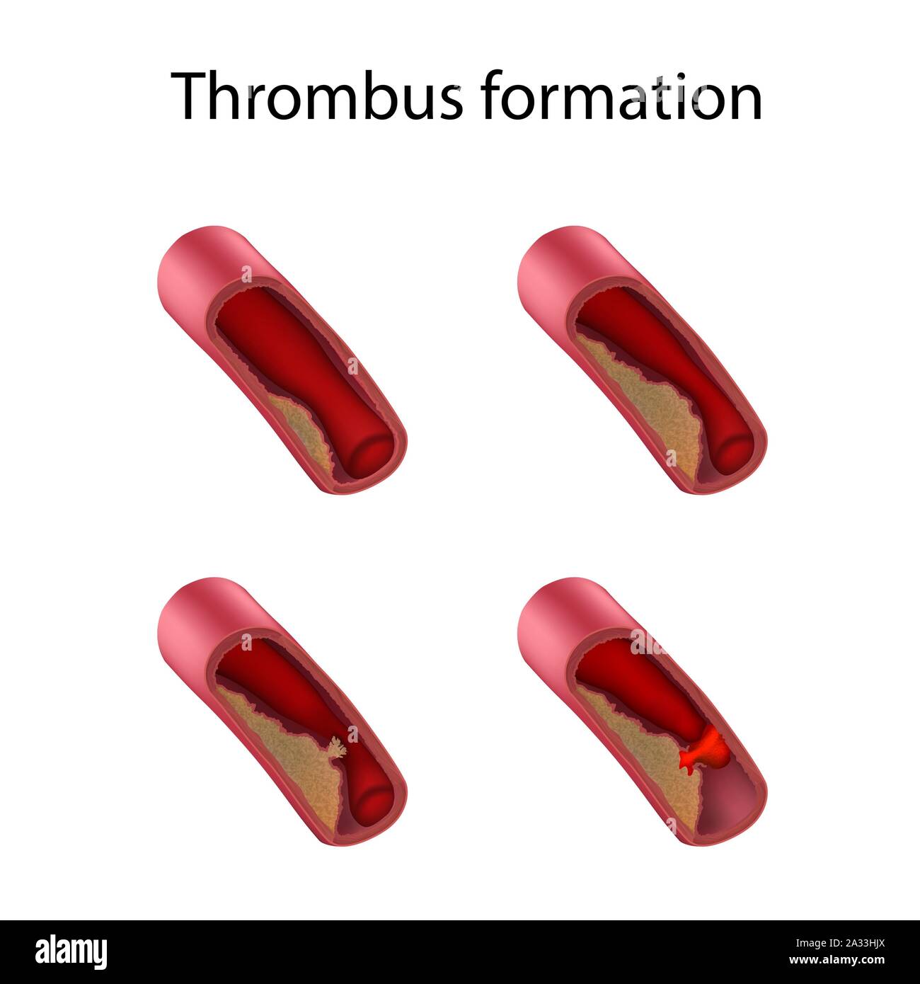 Thrombus formation, illustration Stock Photo - Alamy
