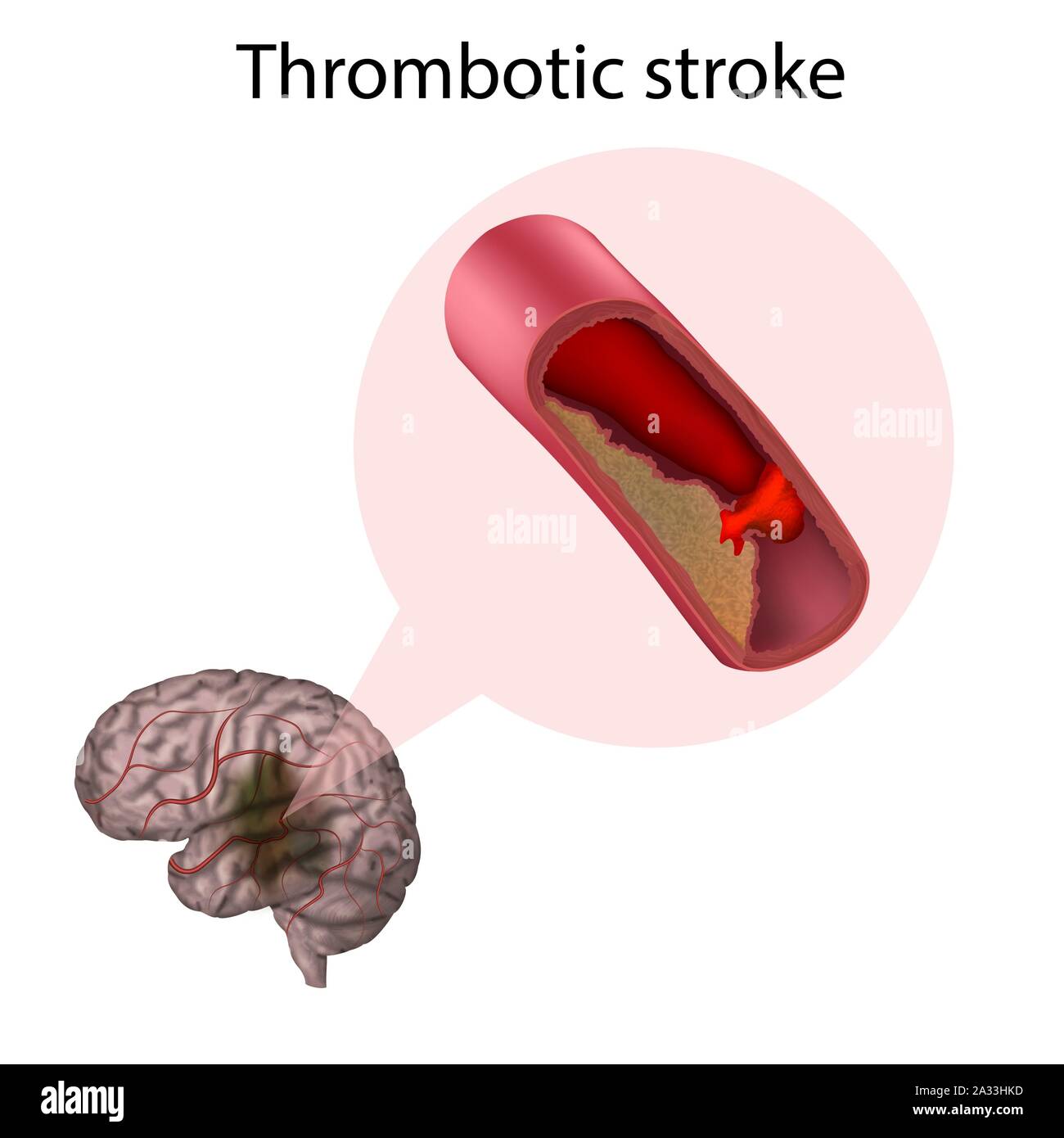 Thrombotic stroke, illustration Stock Photo - Alamy