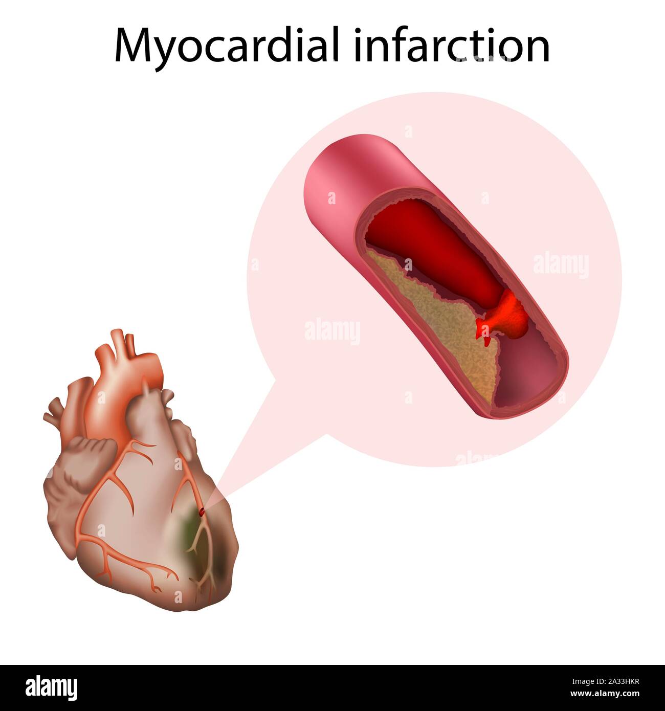 Myocardial infarction, illustration Stock Photo - Alamy