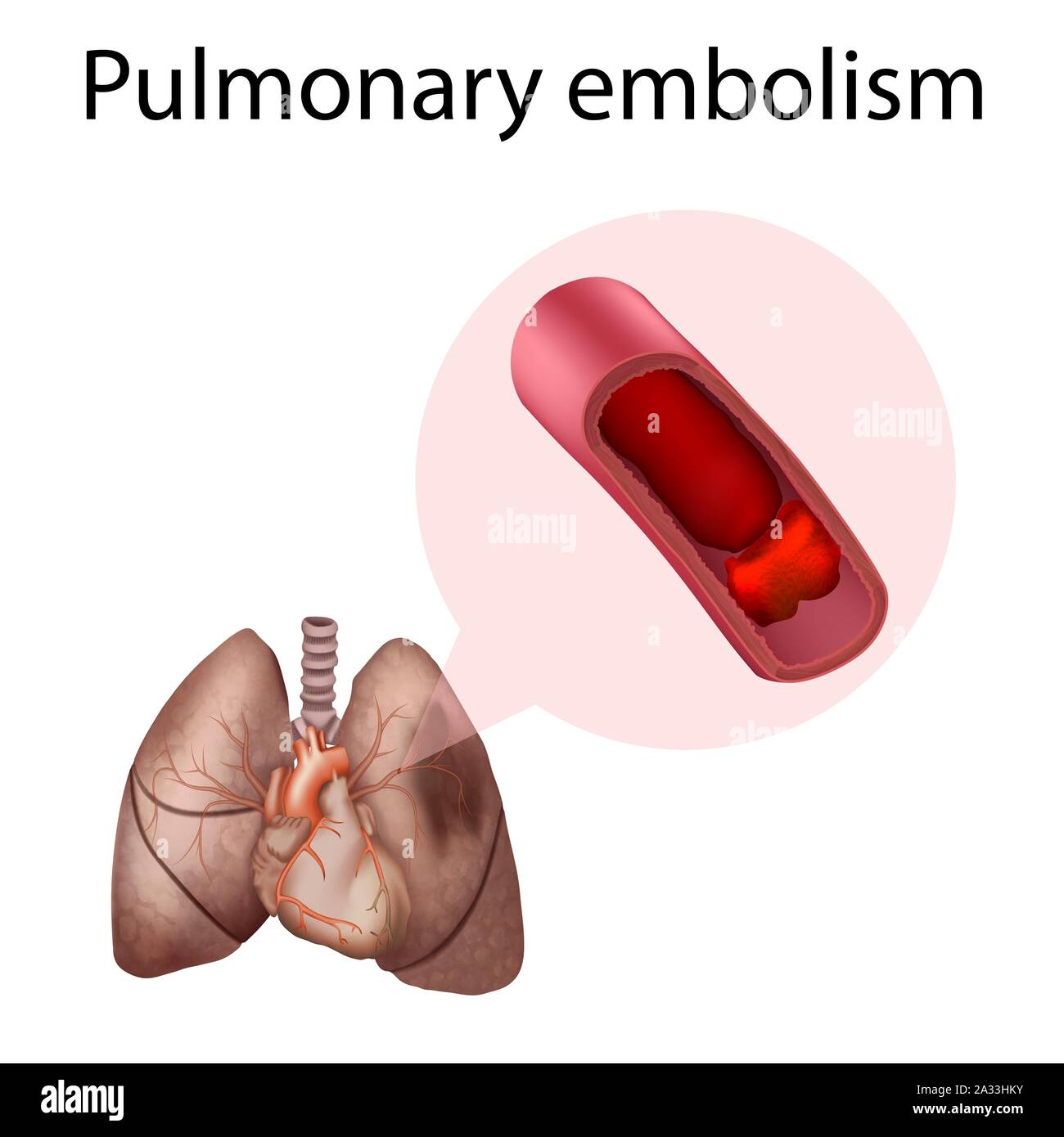 Pulmonary embolism, illustration Stock Photo - Alamy