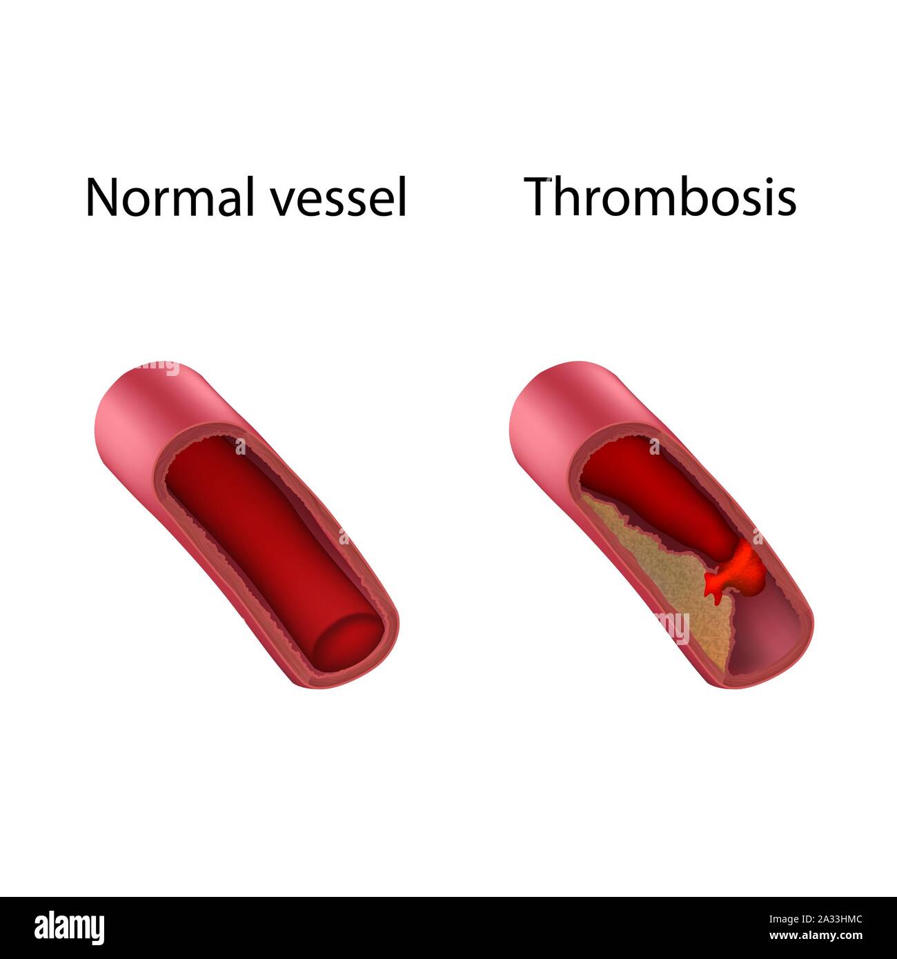 Thrombosis and normal blood vessel, illustration Stock Photo - Alamy