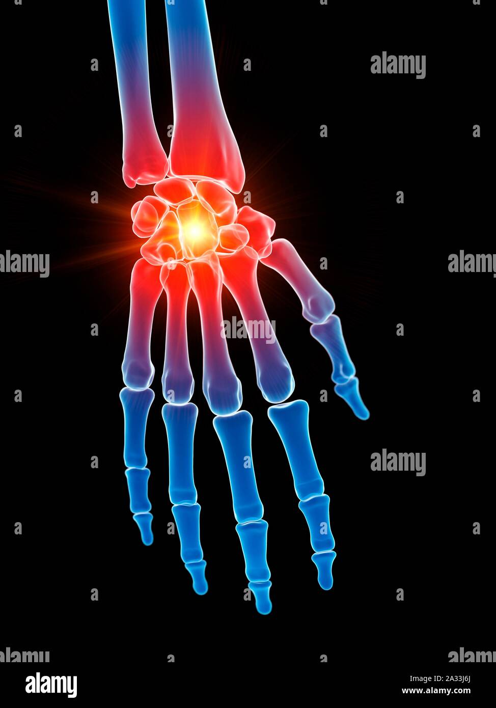 Hand pain, conceptual illustration Stock Photo - Alamy