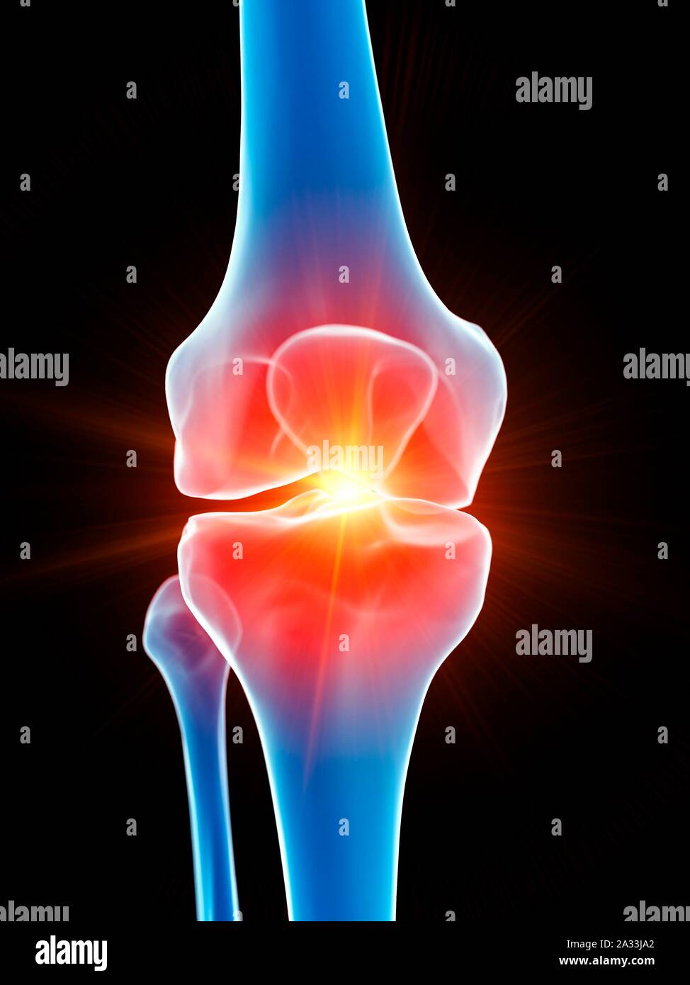 Knee pain, conceptual illustration Stock Photo - Alamy