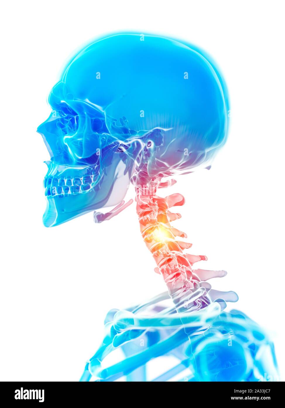 Neck pain, conceptual illustration Stock Photo - Alamy