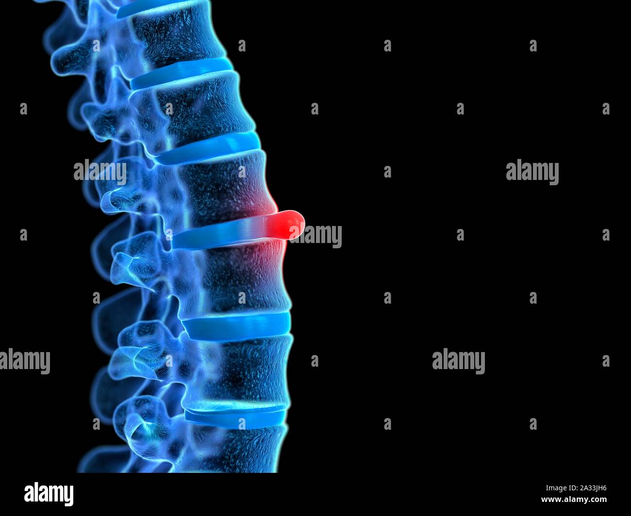 Prolapsed disc hi-res stock photography and images - Alamy