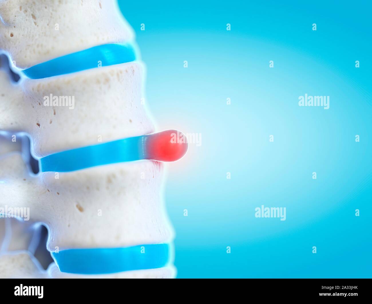 Prolapsed disc hi-res stock photography and images - Alamy