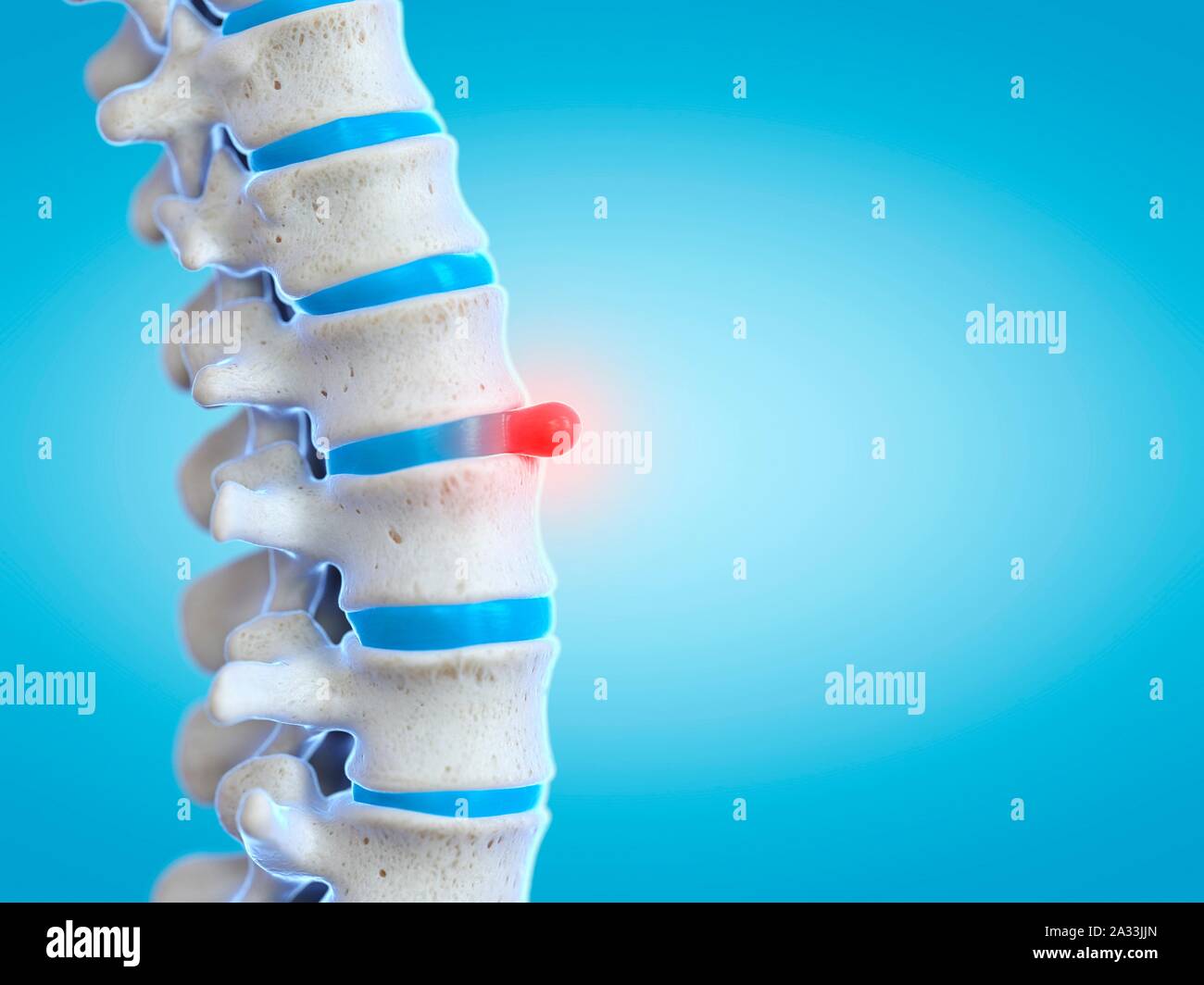 Prolapsed spinal disc, illustration Stock Photo - Alamy