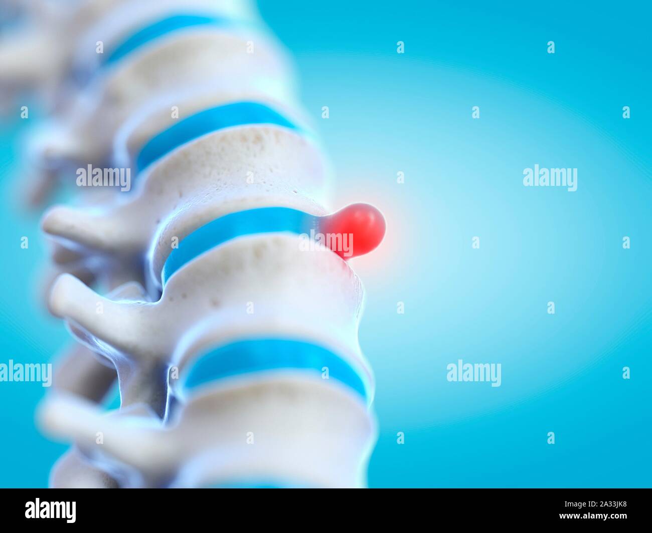 Prolapsed spinal disc, illustration Stock Photo - Alamy