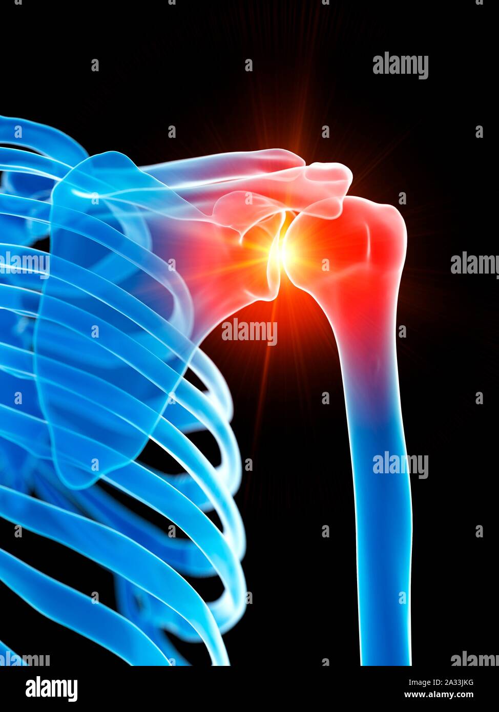 Shoulder pain, conceptual illustration Stock Photo - Alamy Shoulder pain, conceptual illustration Stock Photo - Alamy
