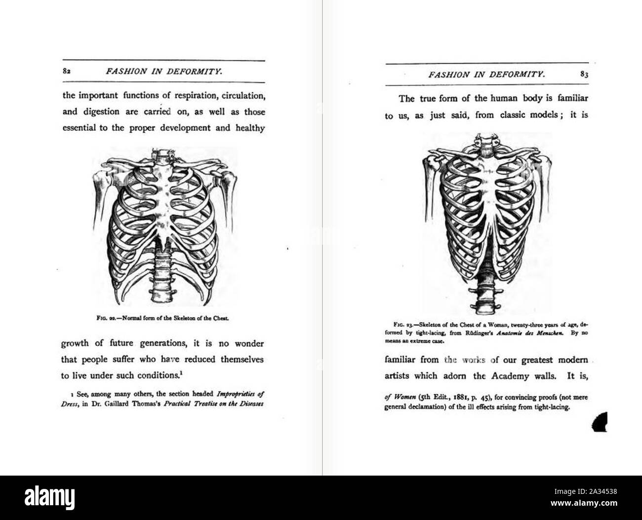 Fashion in deformity - corset Stock Photo - Alamy