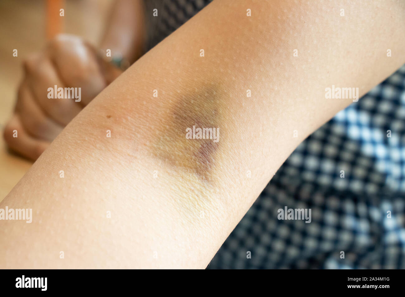 Bruise injury on the female arm background Stock Photo - Alamy
