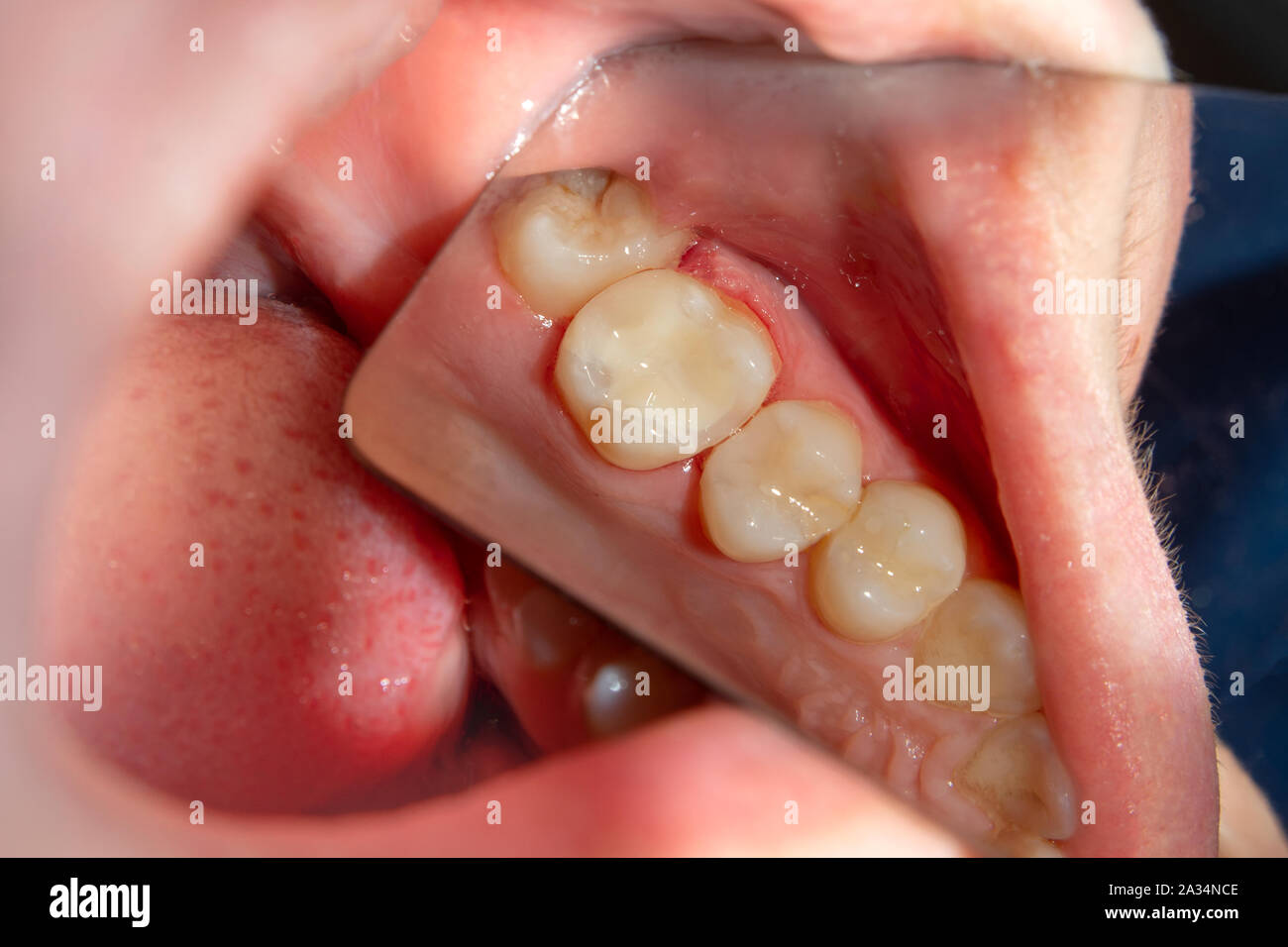 two chewing side teeth of the upper jaw after treatment of caries ...
