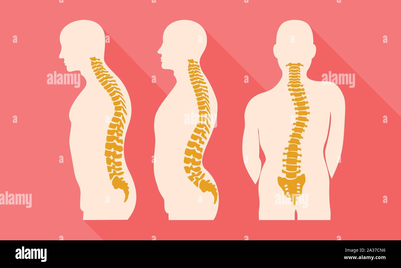 Human spine disease icon. Flat illustration of human spine disease ...