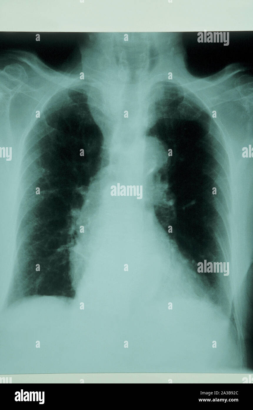 x-rays, pulmonary emphysema Stock Photo - Alamy