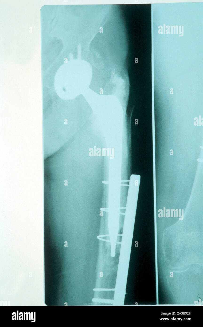 x-rays, prosthesis, hip Stock Photo - Alamy