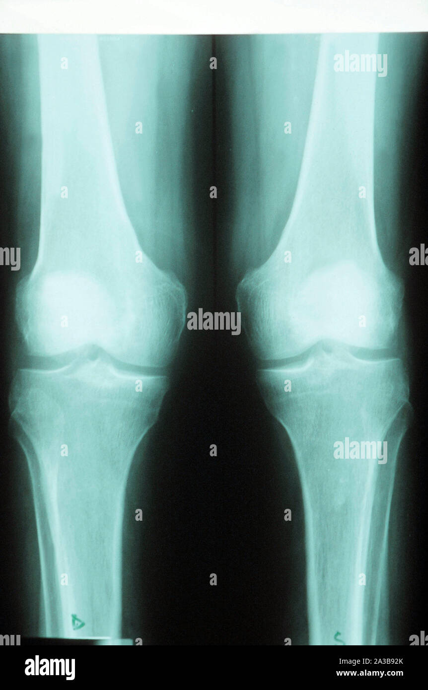Knee arthrosis hi-res stock photography and images - Alamy