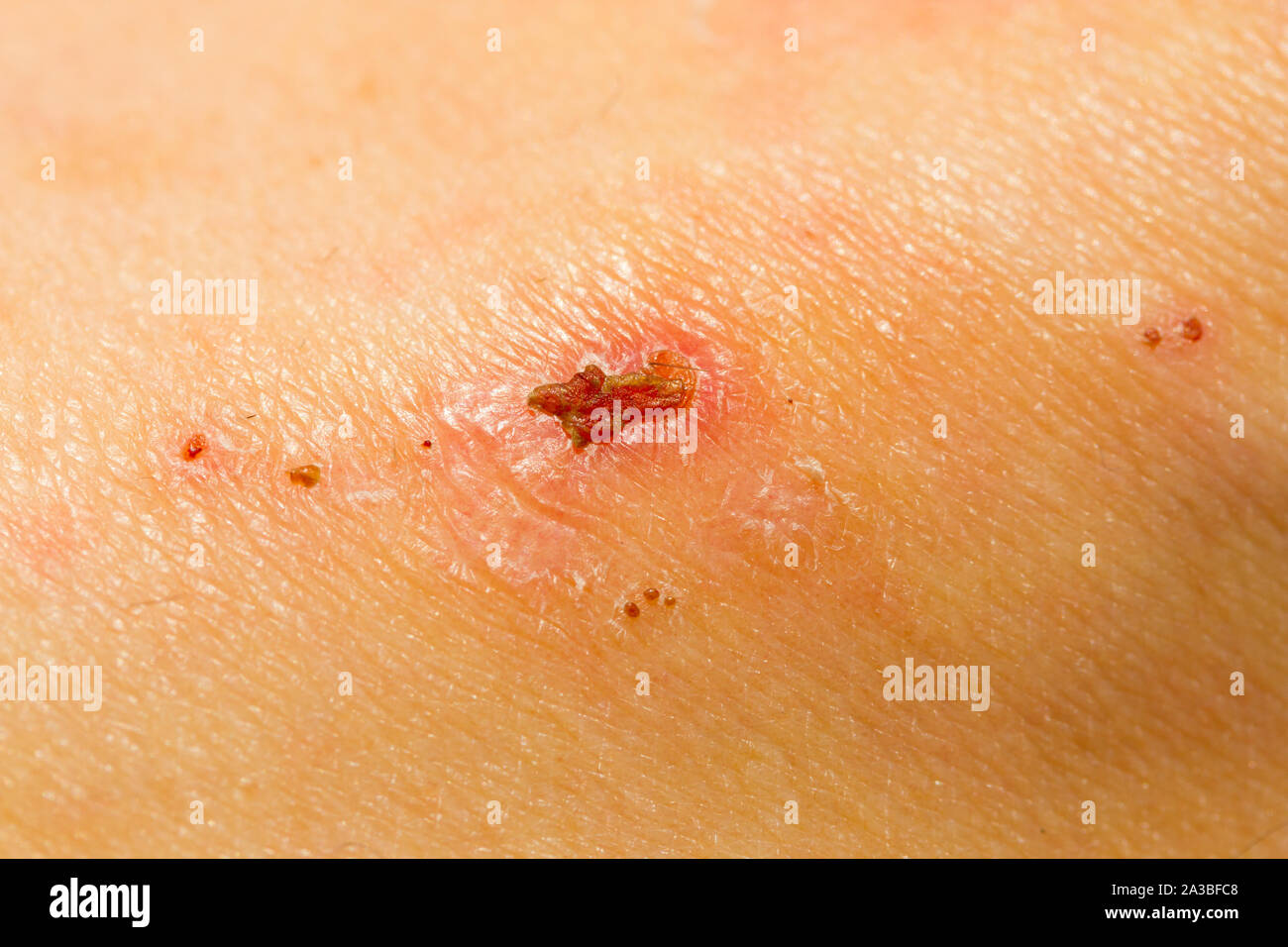 Close up of a scar on skin Stock Photo - Alamy