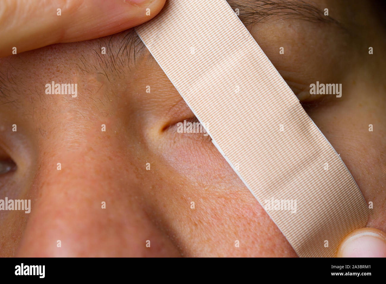 Scar tissue eye hi-res stock photography and images - Alamy