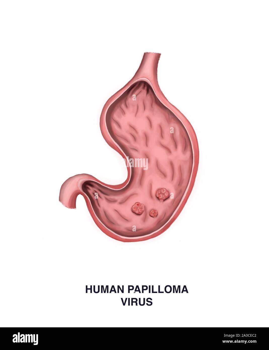 Illustration of papillomatosis of the stomach. Oncology Stock Photo - Alamy