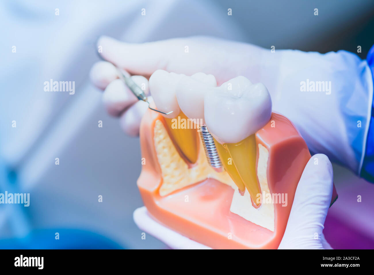 Dentist with tooth implant false teeth. Dentistry and healthcare ...