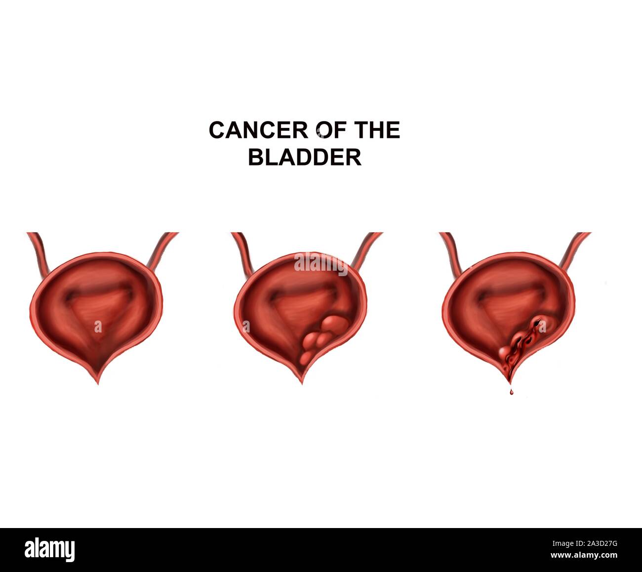 exophytic and endophytic growth of cancer in the bladder Stock Photo ...