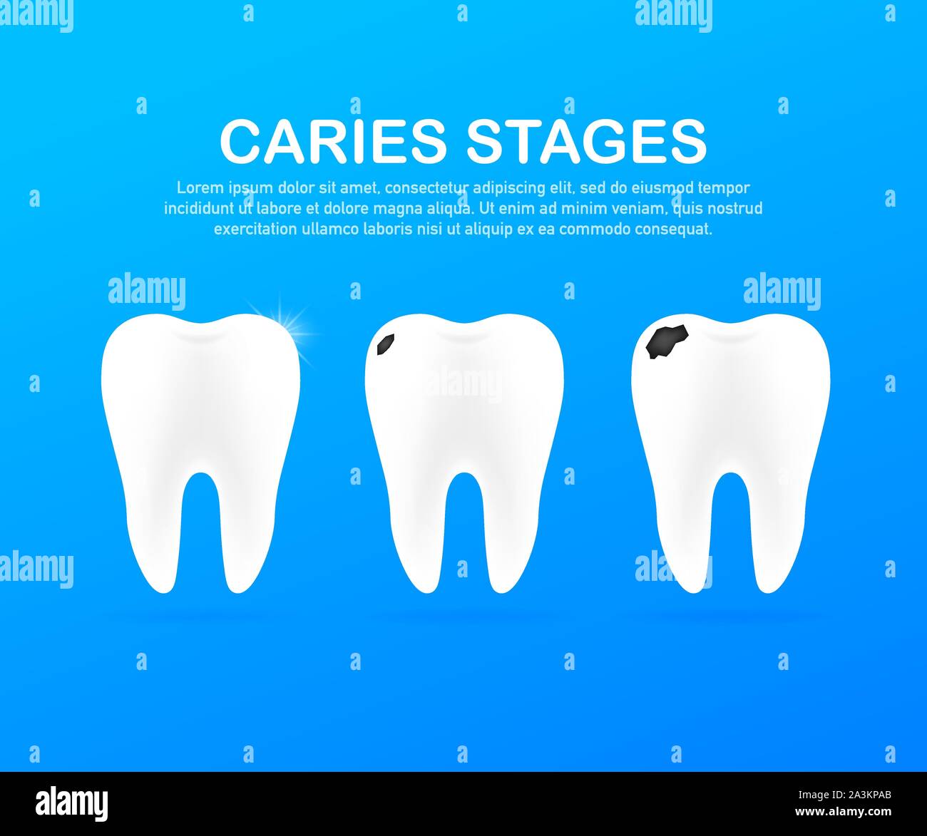 Stage of development of caries. Dental care concept. Healthy Teeth ...