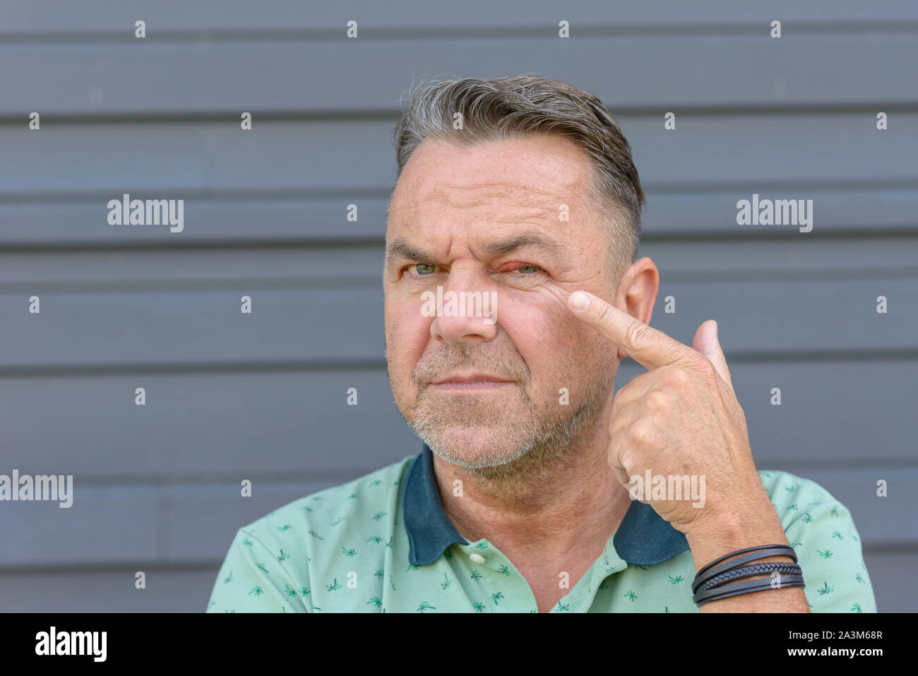Man pointing to an inflamed eye caused by a bacterial infection, stye ...