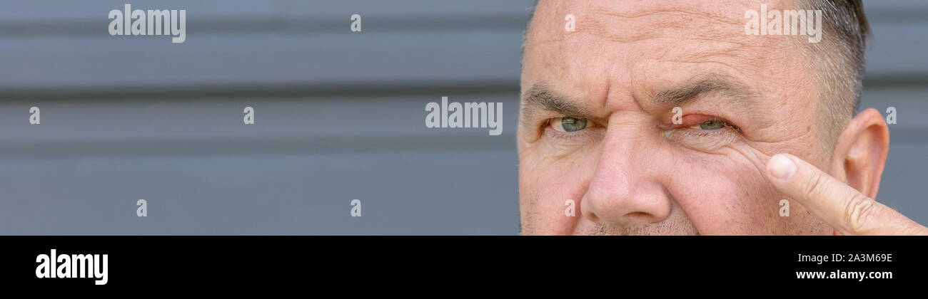 Man Pointing To His Swollen Inflamed Left Eye Showing A Bacterial Infection Or Stye Of The Upper