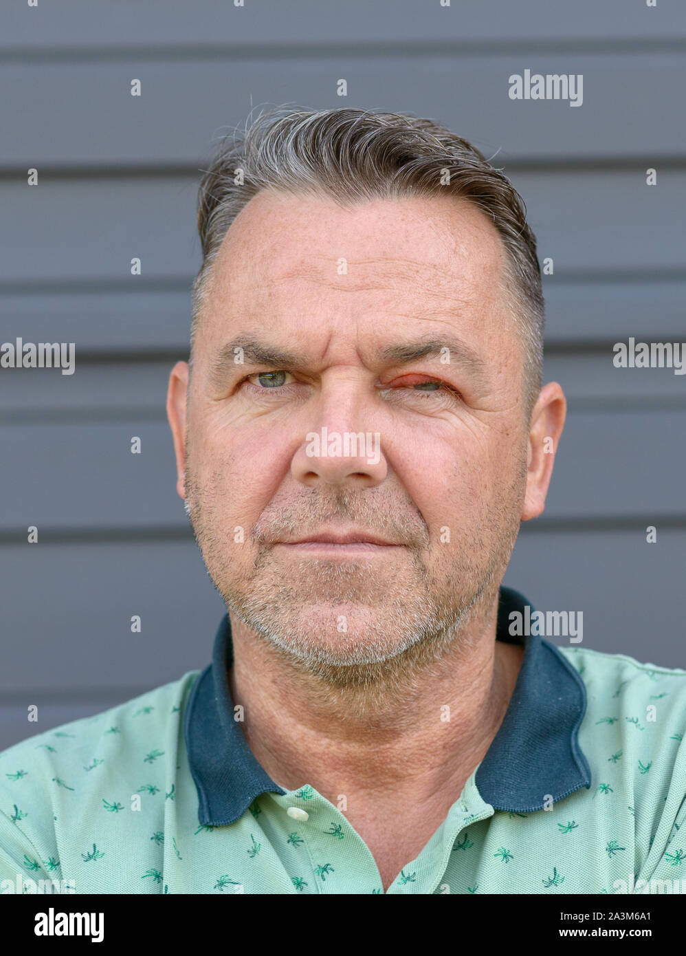 Swollen eyelid hi-res stock photography and images - Alamy
