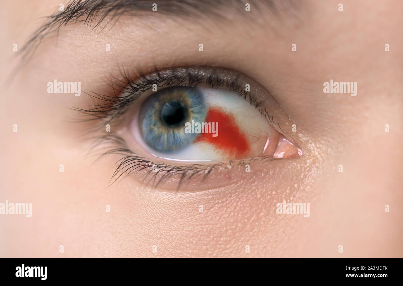Bacterial Conjunctivitis Stock Photos & Bacterial Conjunctivitis Stock ...