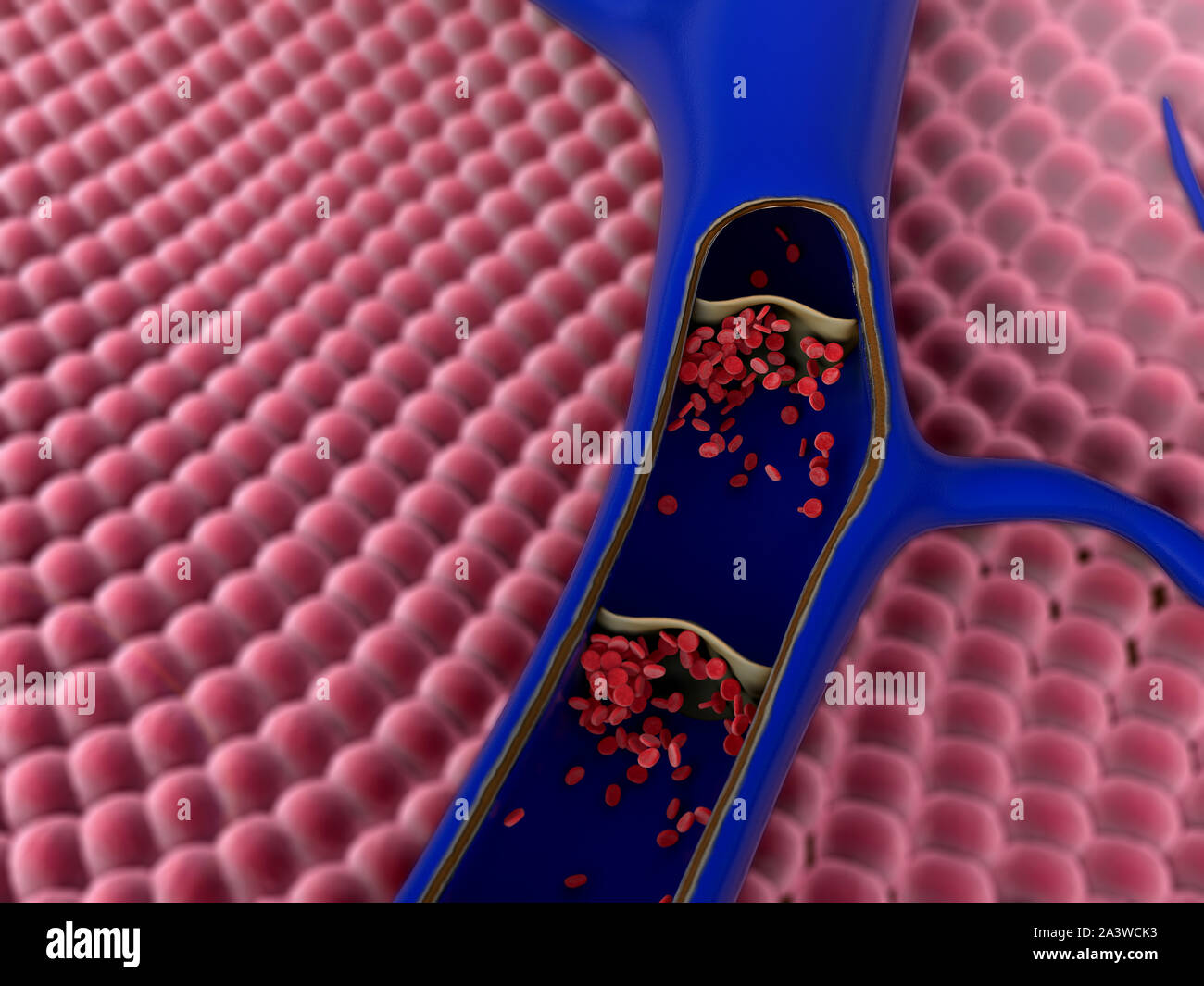 Contraction of blood vessels, a blood clot in the vessels, fat cell in ...