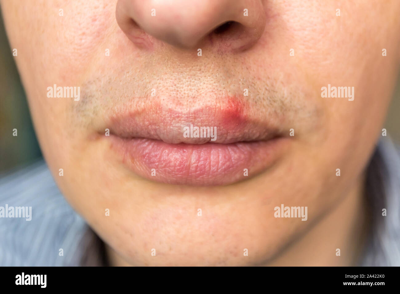 red inflammation and herpes zoster virus on upper male lip Stock Photo ...