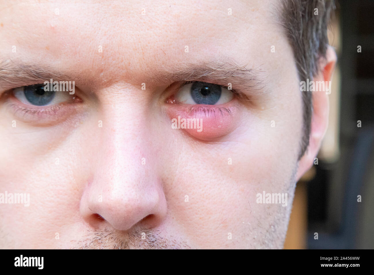 A man with a swollen eyelid due to an infection Stock Photo - Alamy