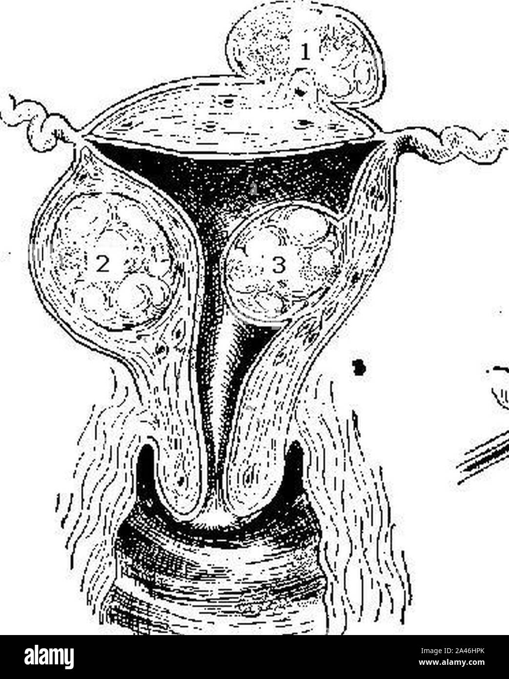 Fibroid Cut Out Stock Images & Pictures - Alamy