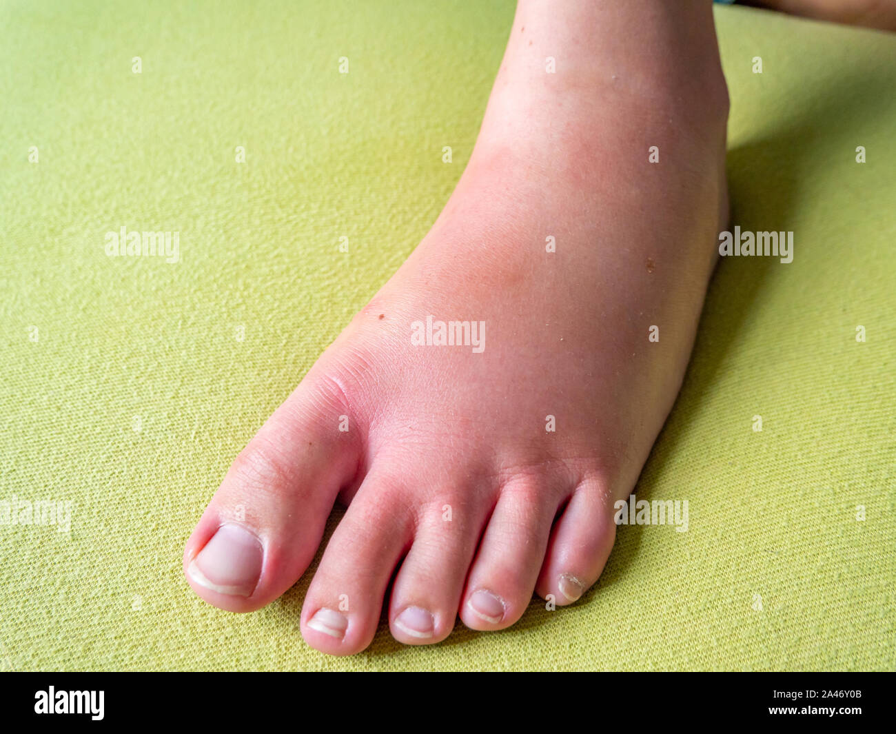 Sepsis skin hi-res stock photography and images - Alamy