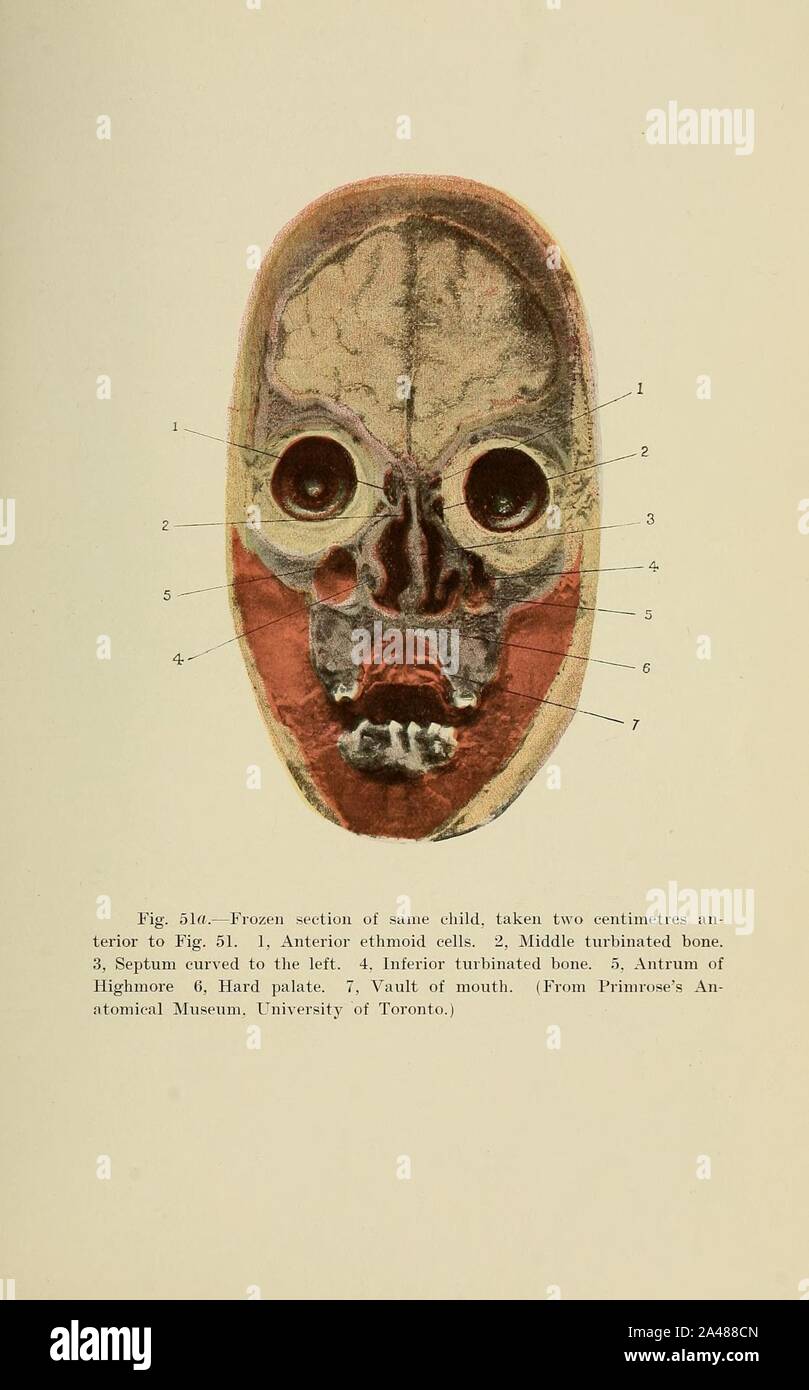 Fig. 51a. Frozen section of the head of a child aged five years Stock ...