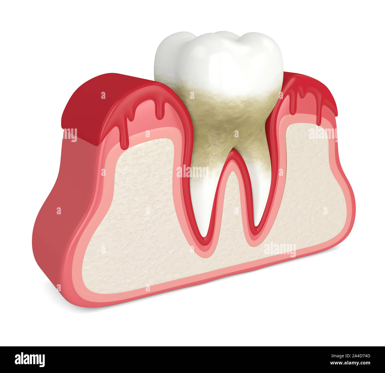 Periodontal Disease Bleeding Gums at Howard Bradshaw blog