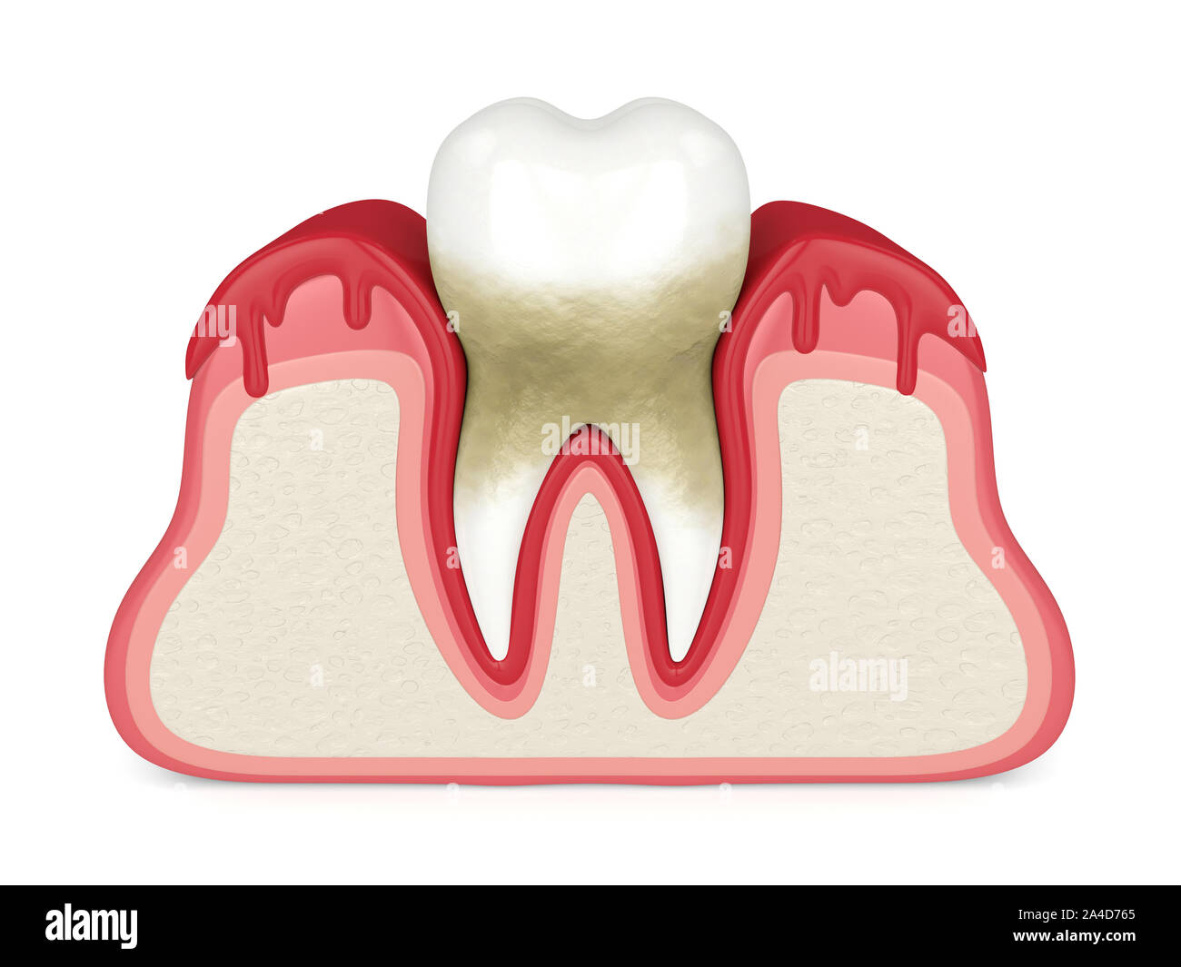3d render of tooth in bleeding gums over white background. Periodontal ...