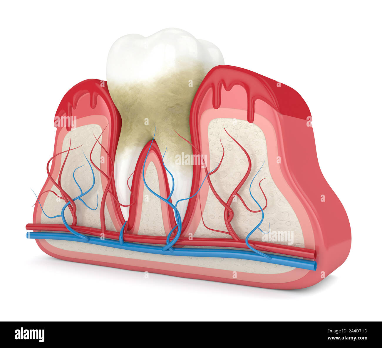 3d render of tooth in bleeding gums over white background. Periodontal ...