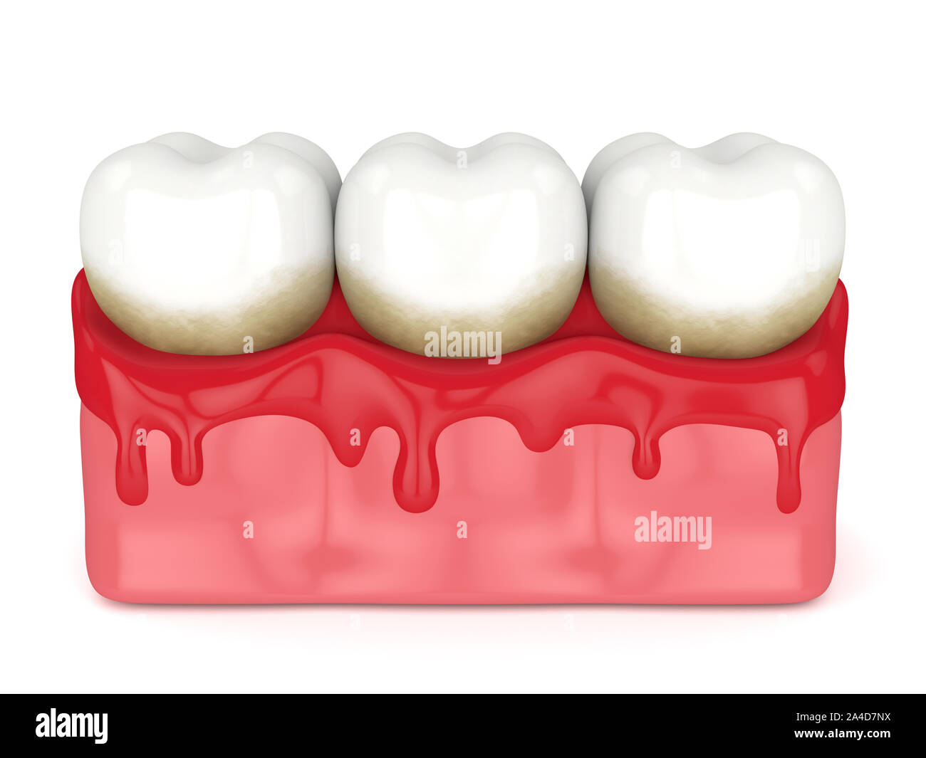 Periodontal desease hi-res stock photography and images - Alamy